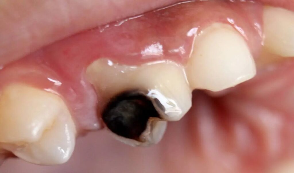 Dental Caries, its Causes, Symptoms, Prevention, and Treatment ...